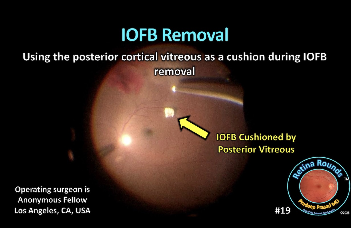 IOFB Removal