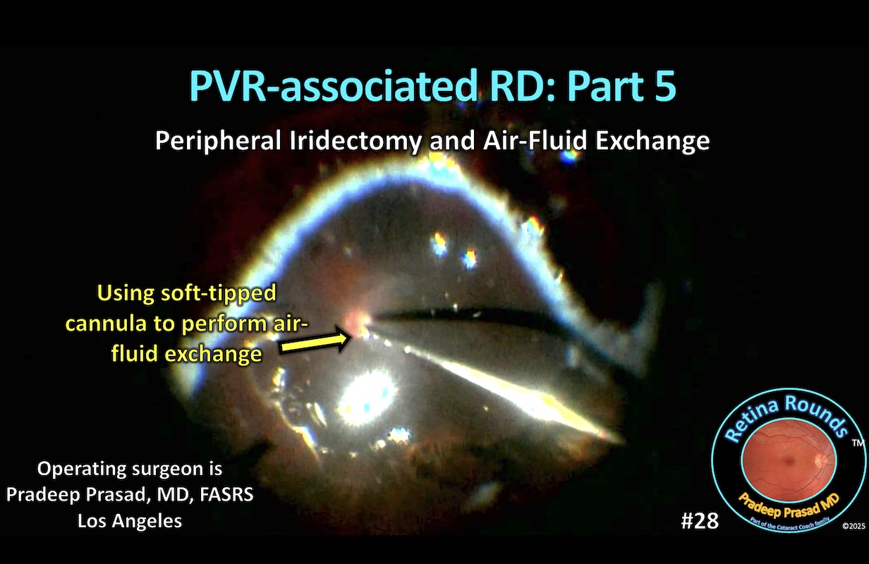 Peripheral iridectomy creation and air-fluid exchange