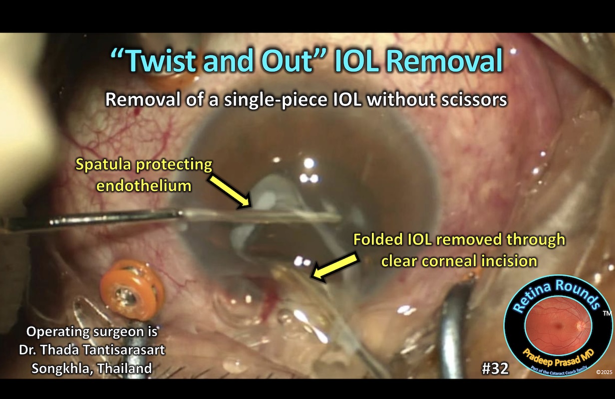 Twist and out technique for iol removal