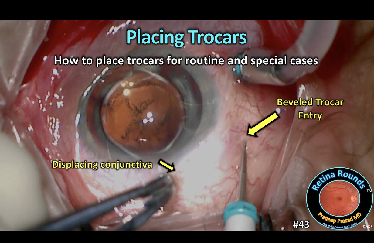 Trocar placement for vitreoretinal surgery