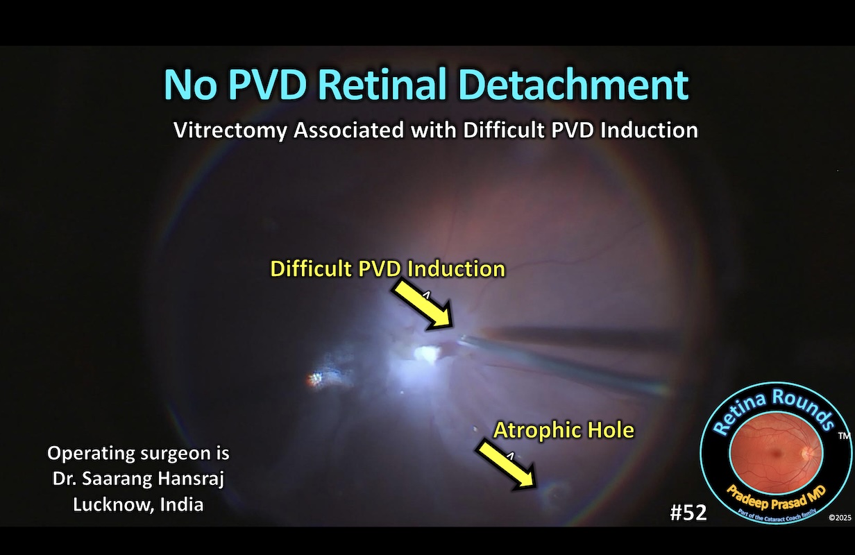 Retinal detachment not associated with a posterior vitreous detachment