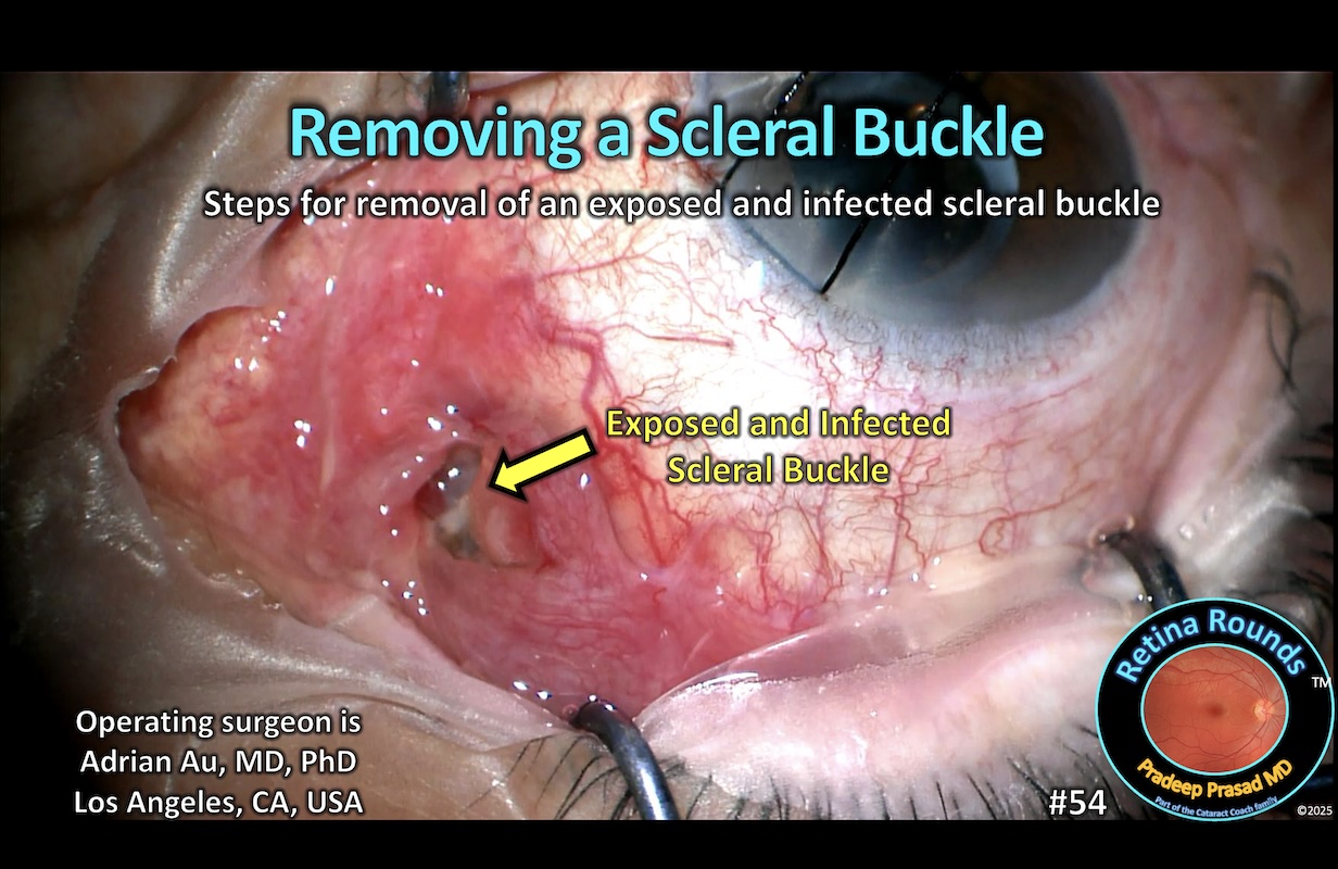 How to remove a scleral buckle