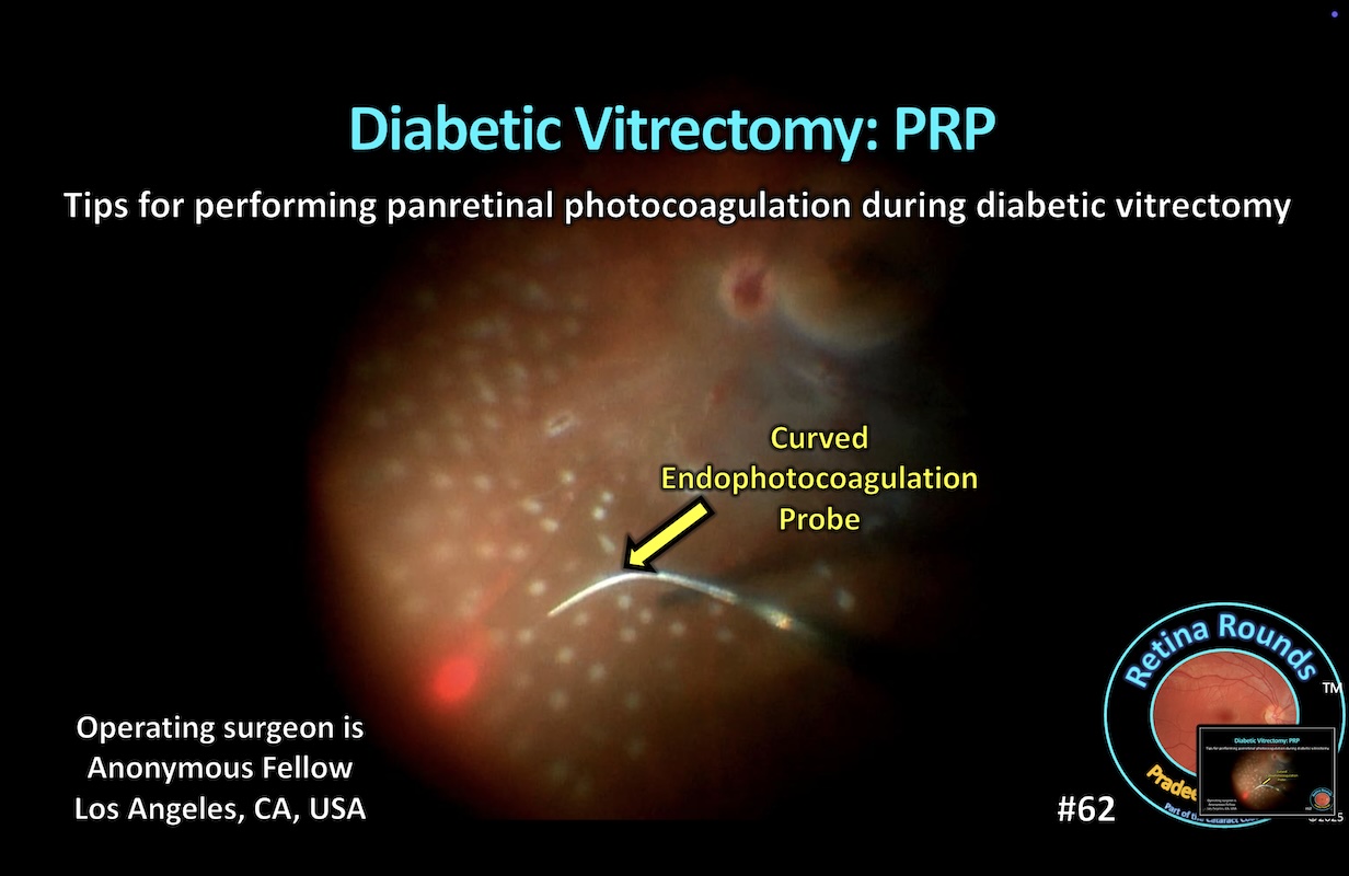 Panretinal photocoagulation during diabetic vitrectomy