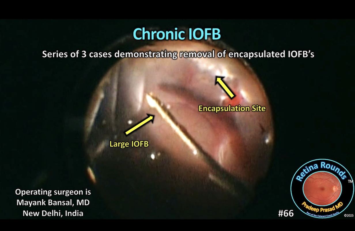 Chronic intraocular foreign body (IOFB) removal