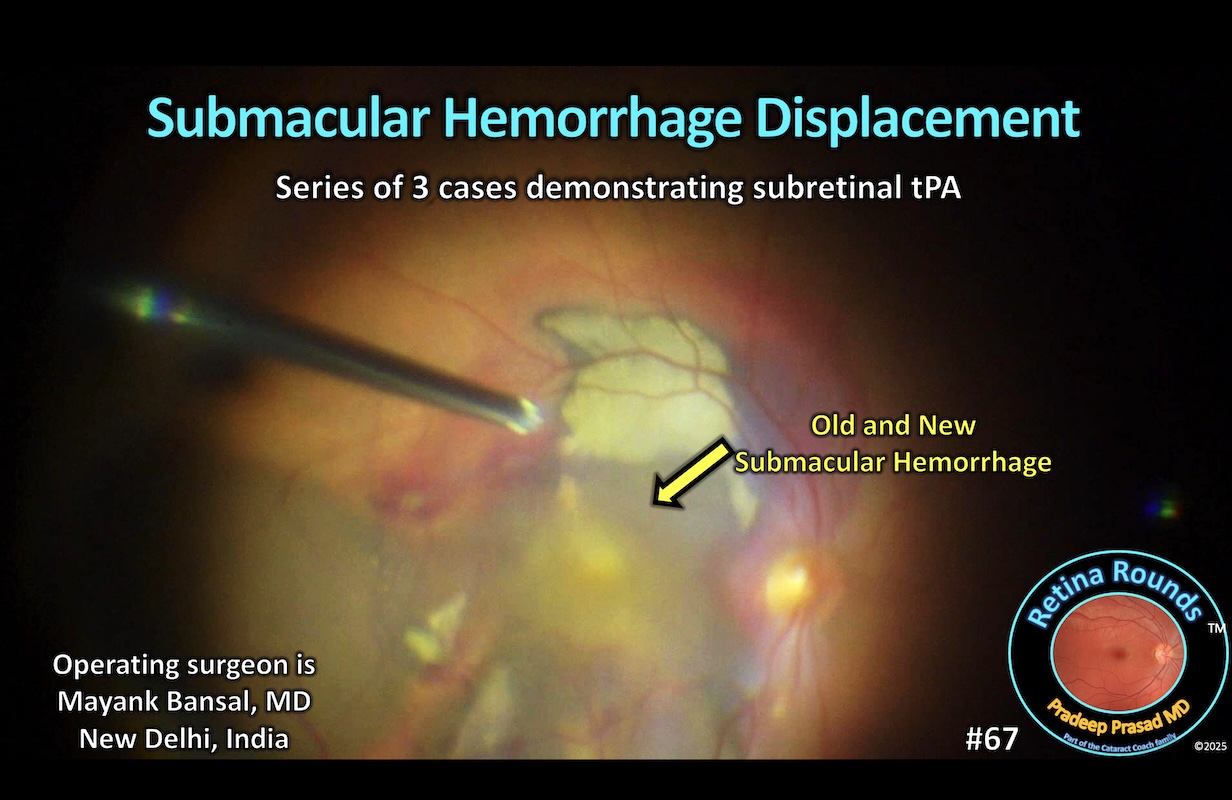 Submacular hemorrhage displacement