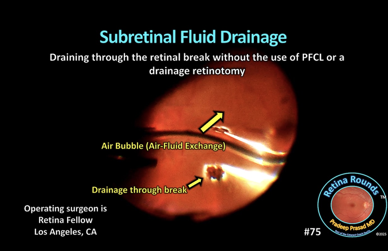Drainage of subretinal fluid during vitrectomy for retinal detachment
