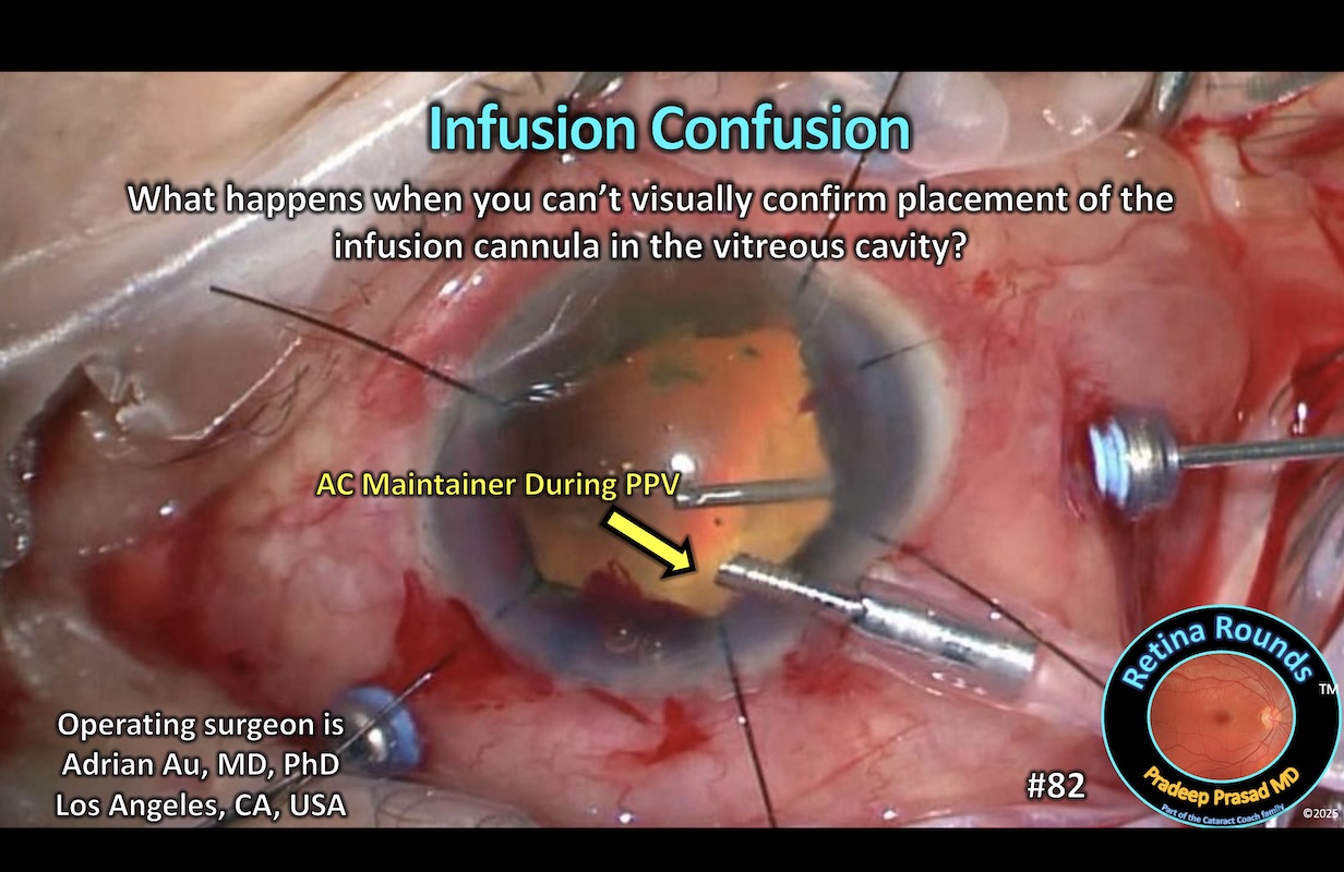 Vitreous hemorrhage – Retina Rounds