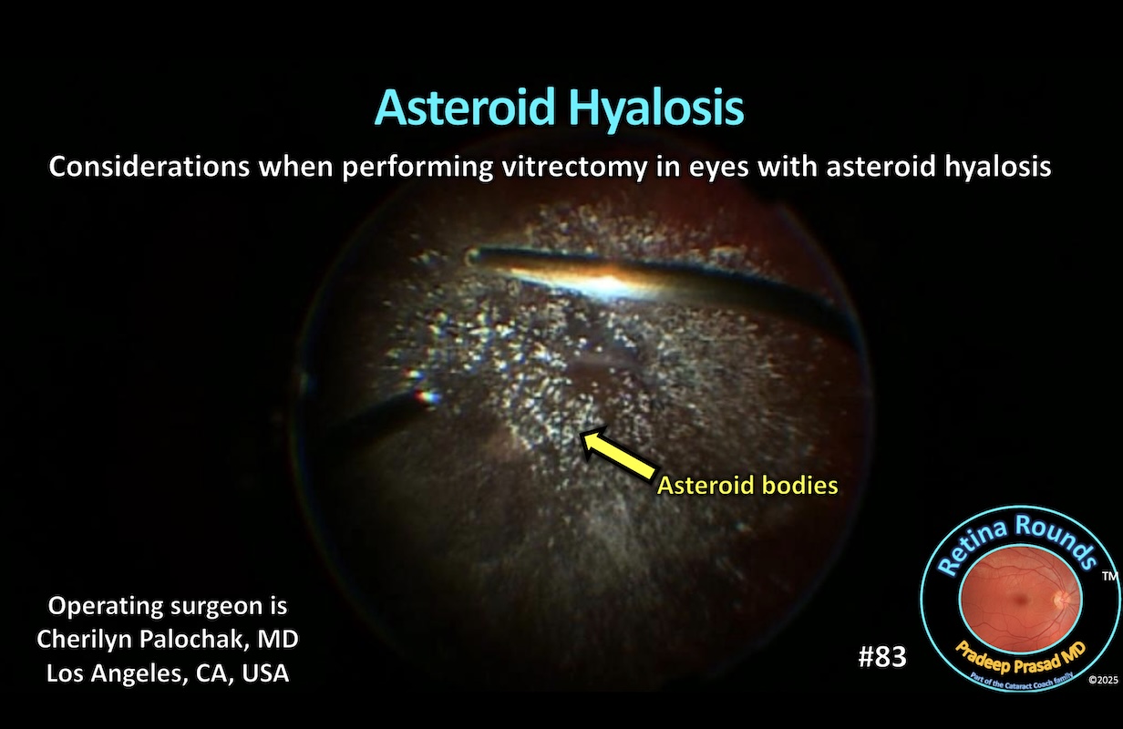 Vitrectomy for asteroid hyalosis and tractional retinal detachment