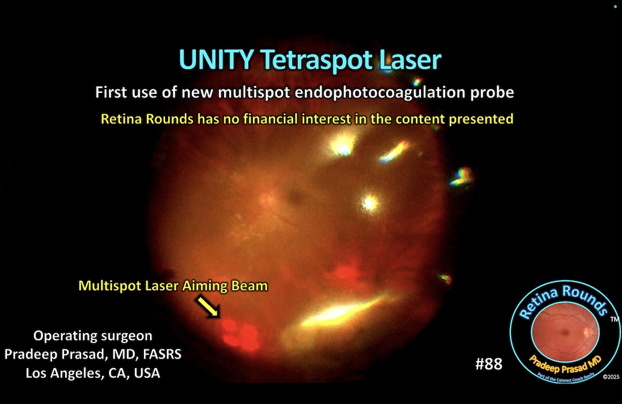 First impressions with the new UNITY Tetraspot Laser