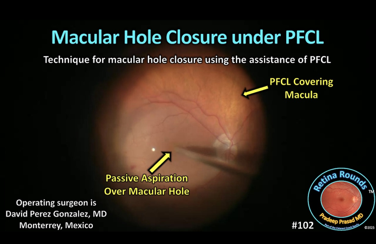 Macular hole closure under PFCL