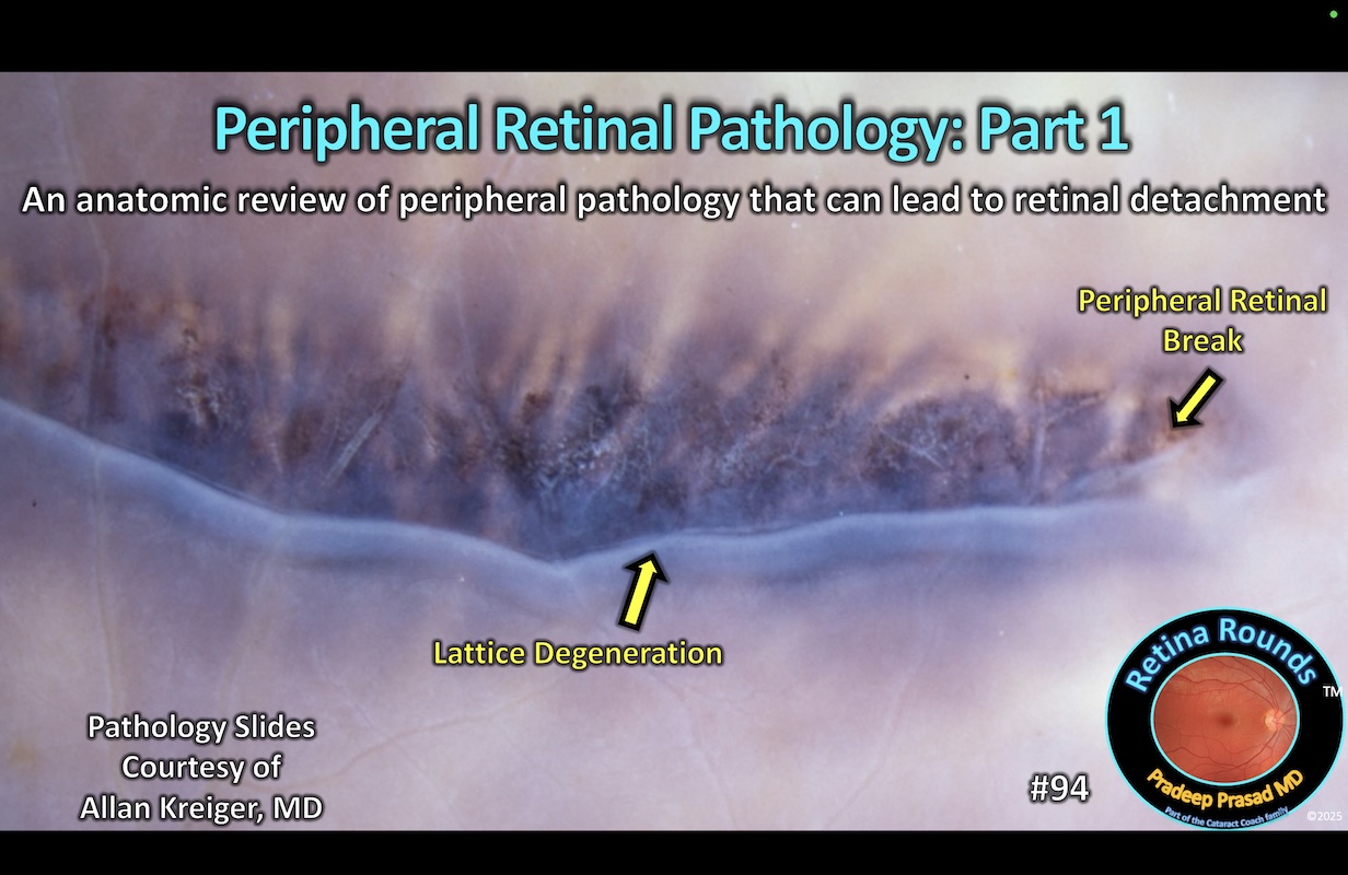 Peripheral retinal pathology that predisposes to a retinal tear or ...