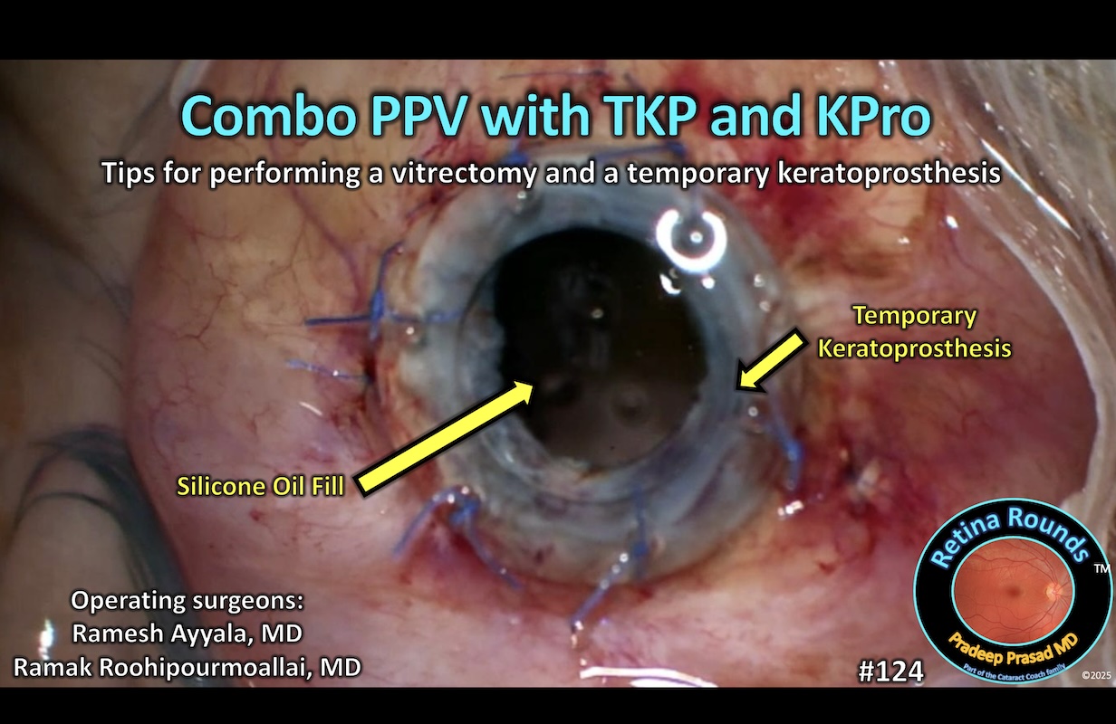 Combination vitrectomy with TKP and Boston Type 1 KPro implantation
