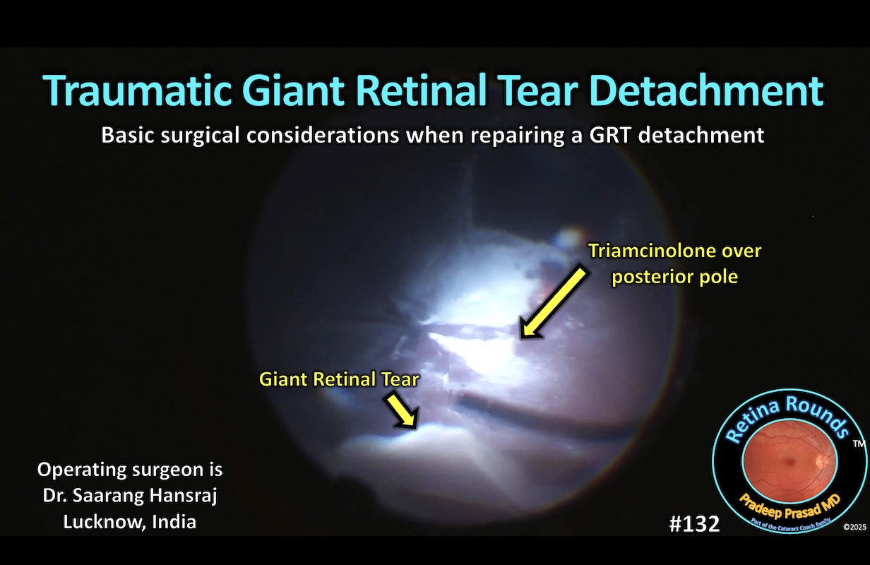 Surgical considerations when repairing a giant retinal tear detachment