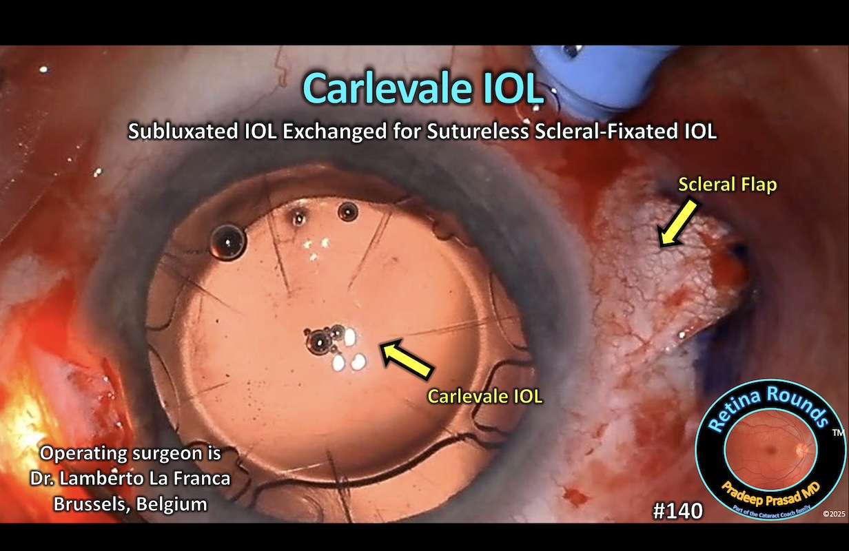 Carlevale IOL implantation