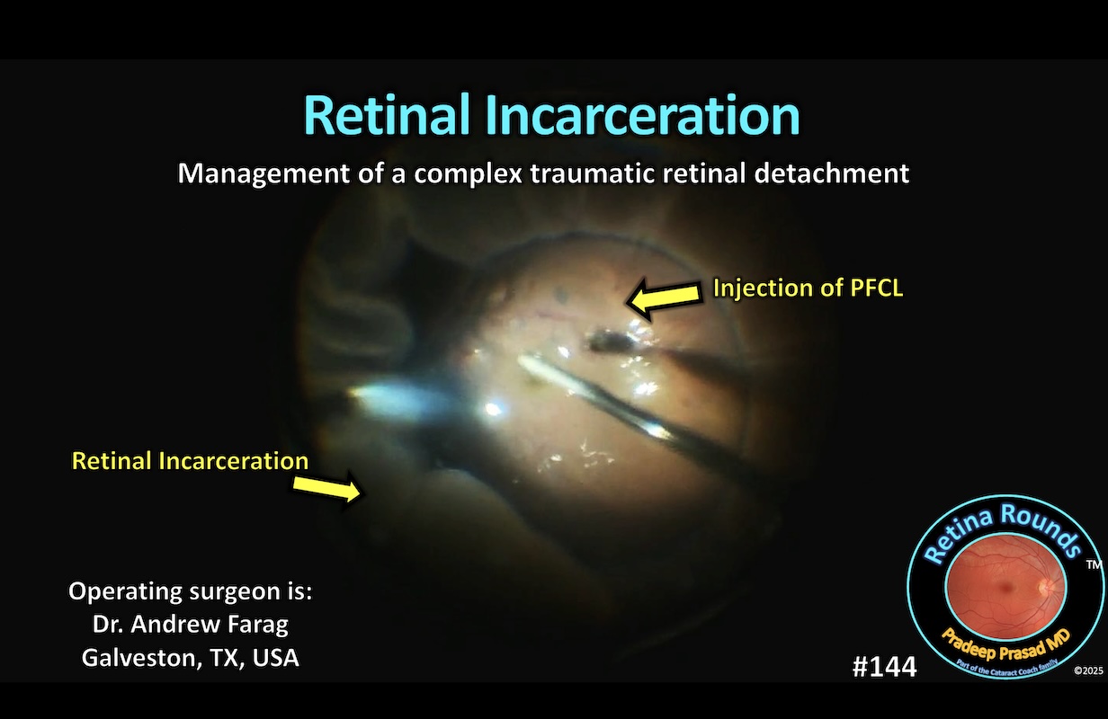 Management of traumatic retinal detachment with retinal incarceration
