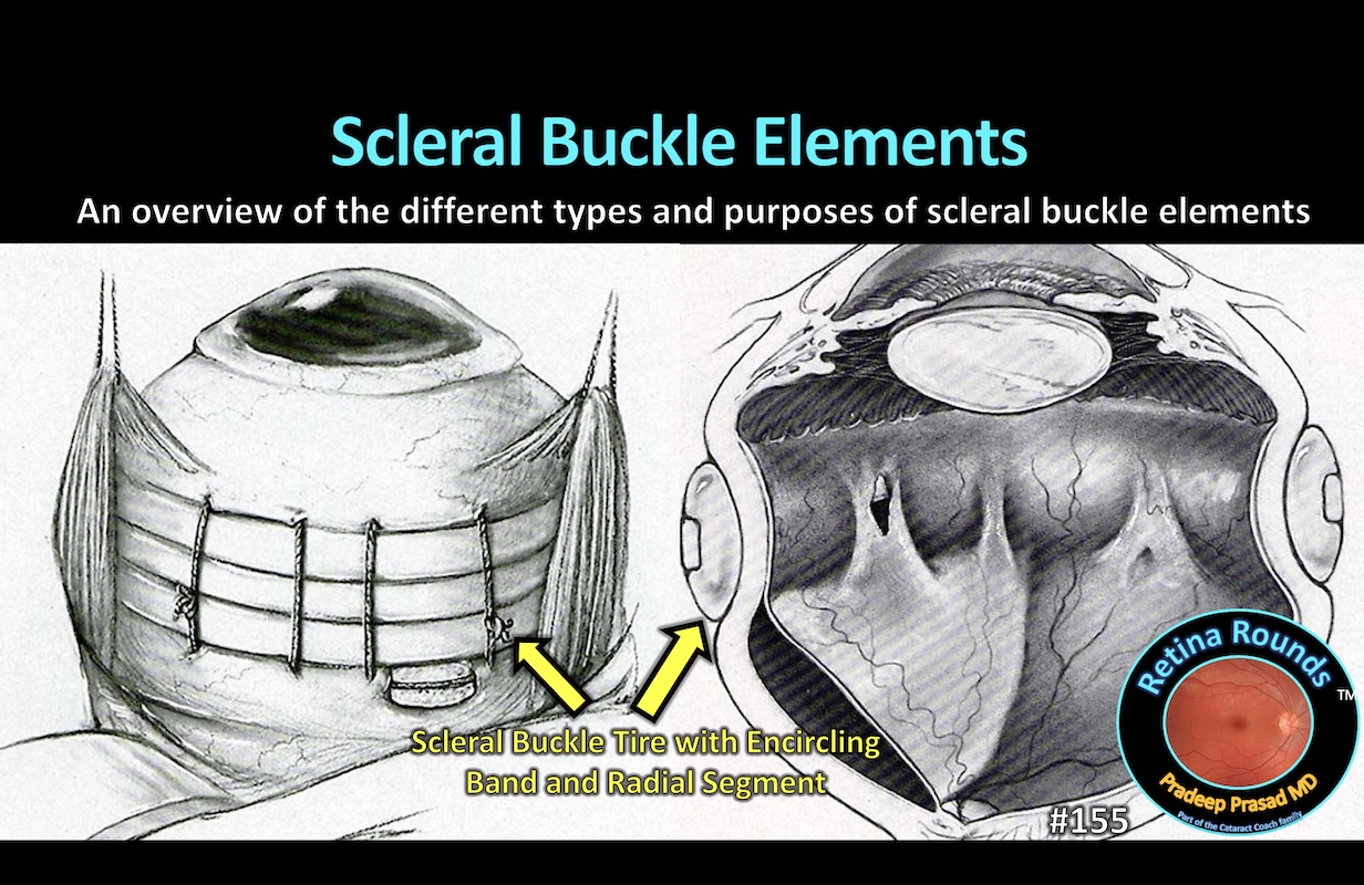An overview of the different types of scleral buckle elements