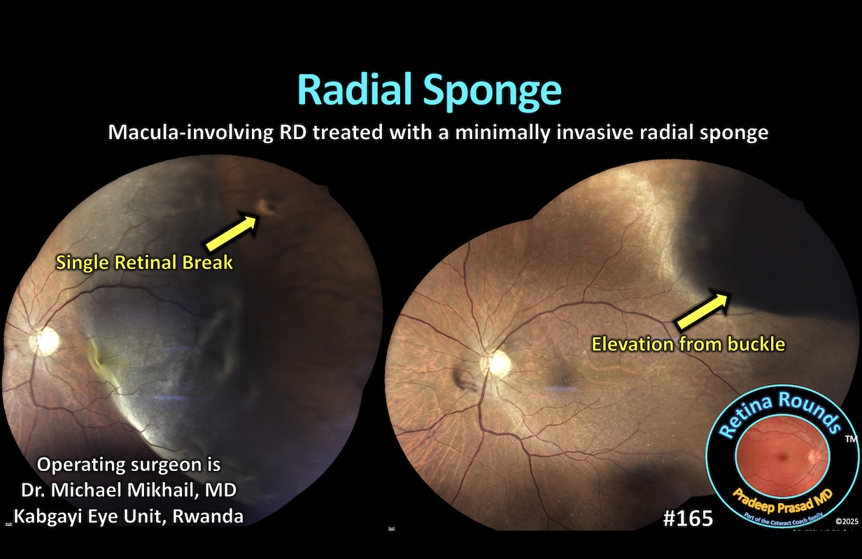 Macula-involving retinal detachment treated with a minimally-invasive ...