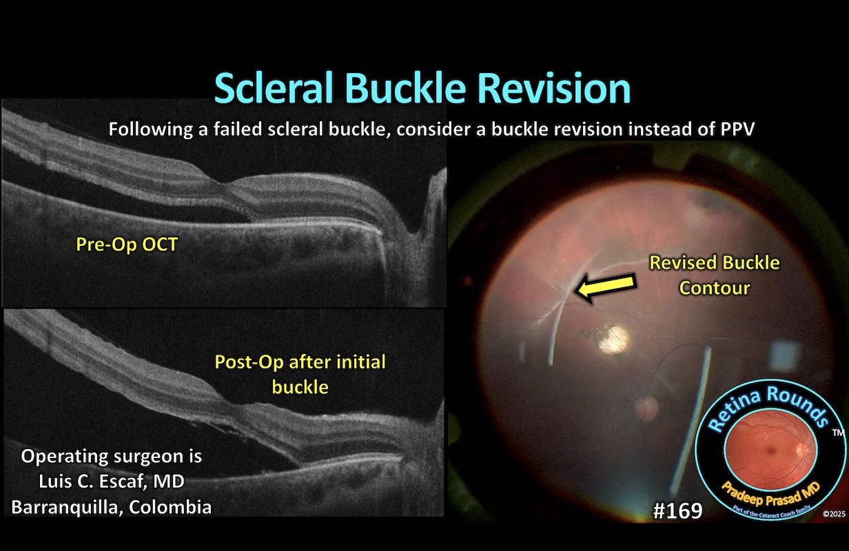 Scleral buckle revision following primary buckle failure
