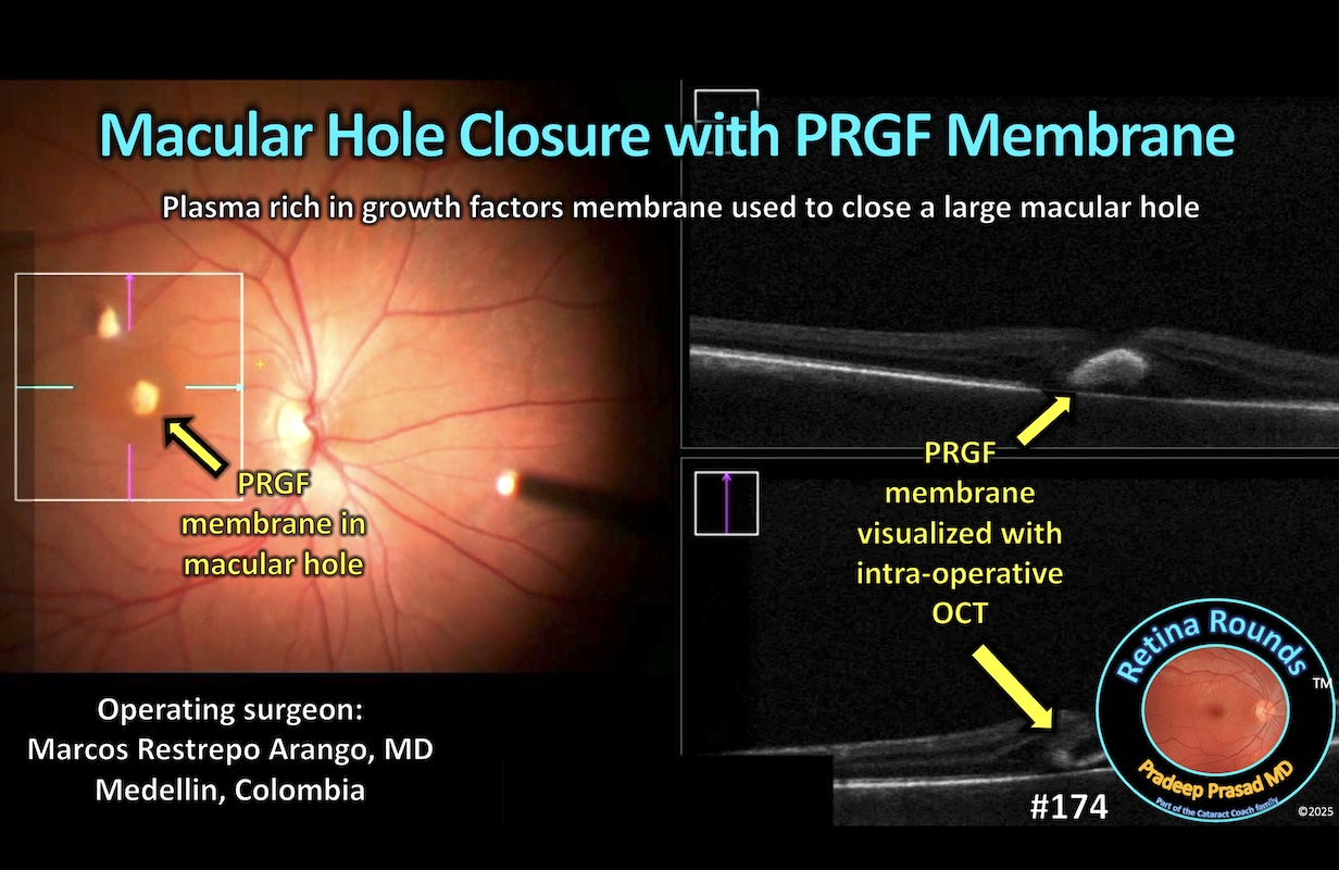 Macular hole closure using a PRGF membrane