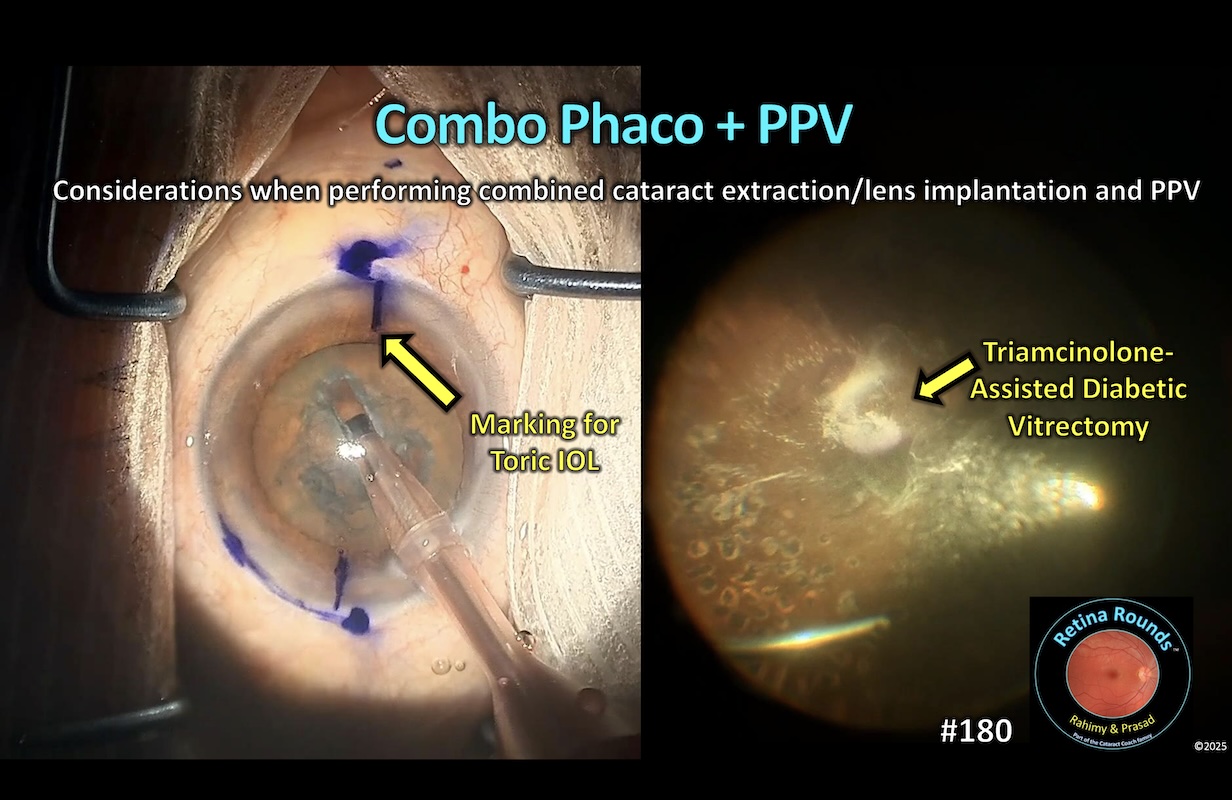 Combination cataract surgery and pars plana vitrectomy.