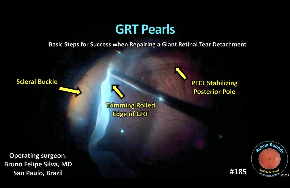 Pearls for repairing a giant retinal tear-associated retinal detachment