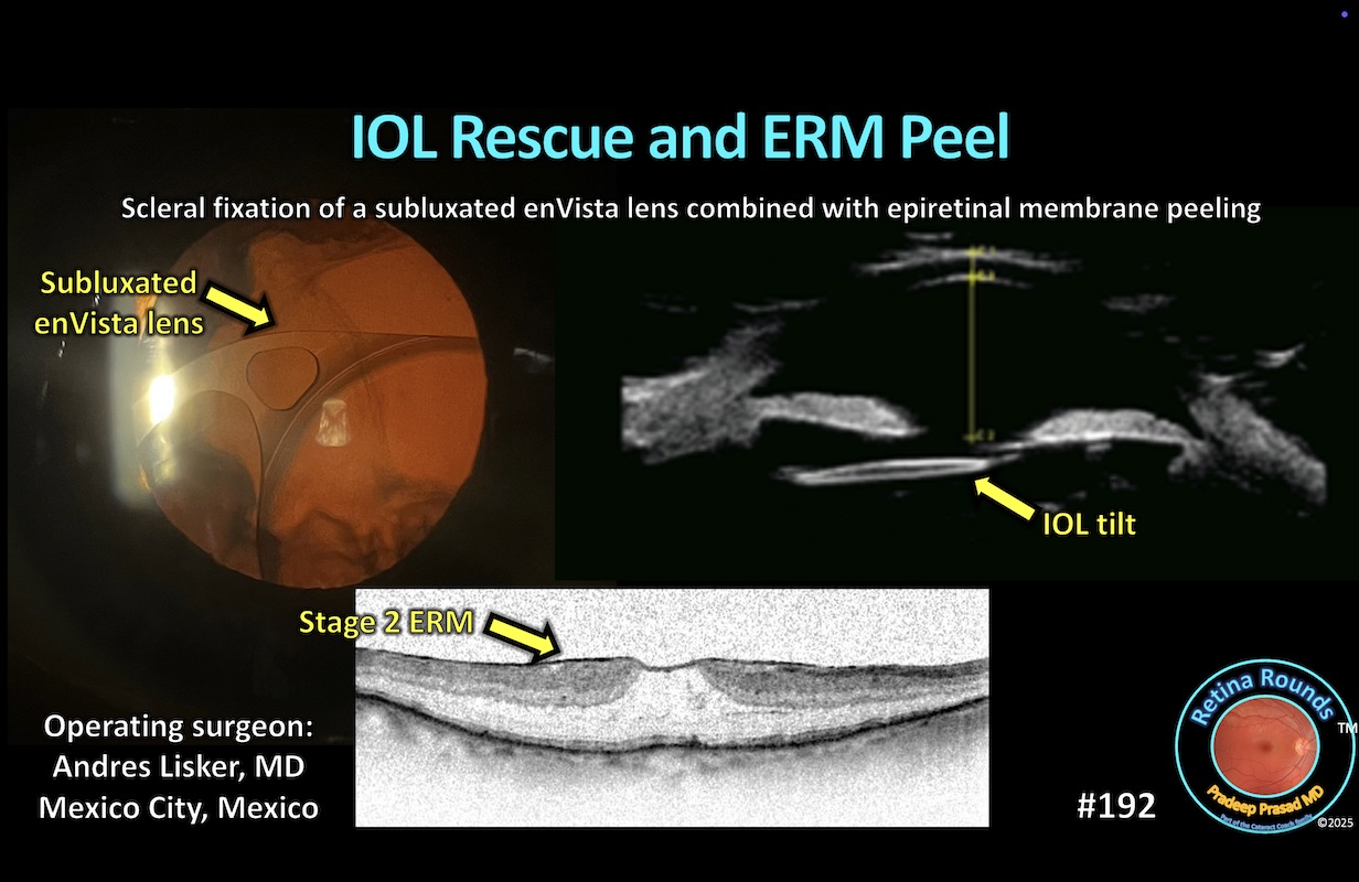 Scleral fixation of a subluxated enVista lens with ERM peeling