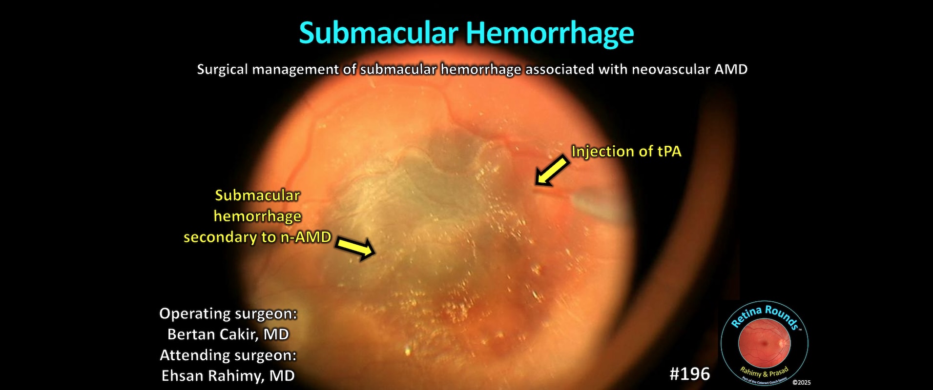 Submacular Hemorrhage Displacement