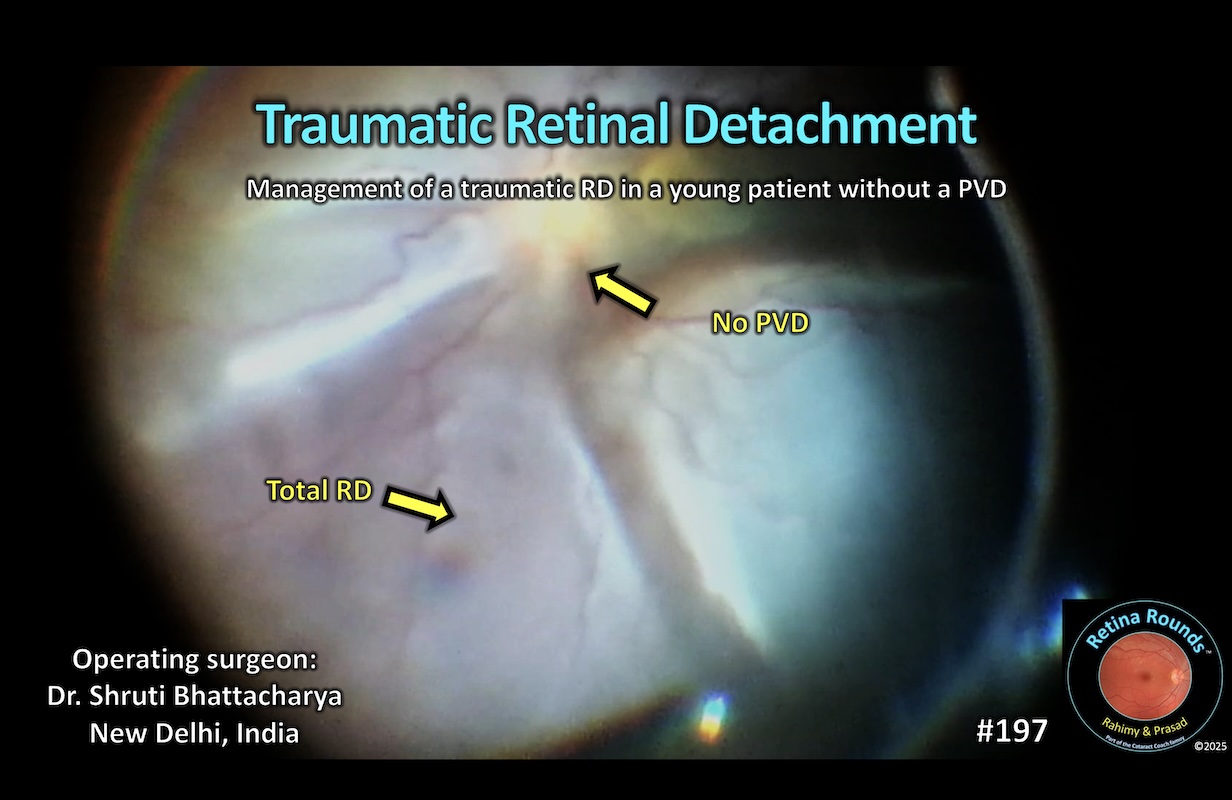 Traumatic Retinal Detachment