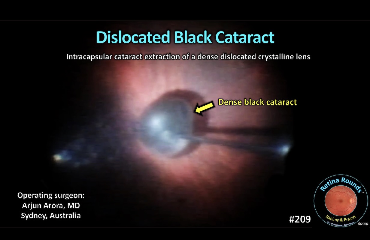 Dislocated Black Cataract